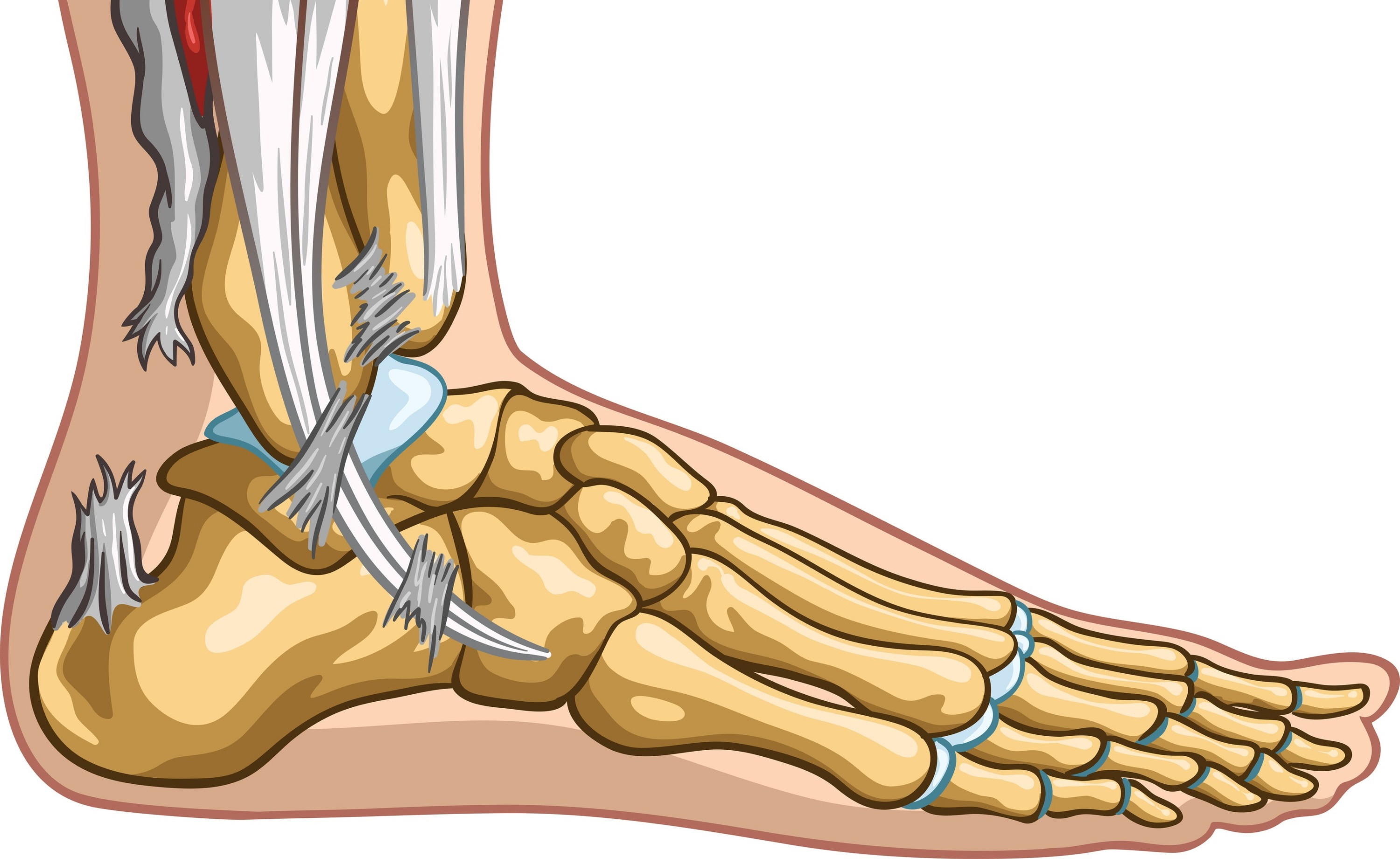 ACHILLES TENDON RUPTURE